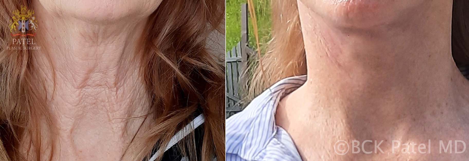 Cosmetic & Reconstructive Surgery by Dr. Bhupendra C. K. Patel MD